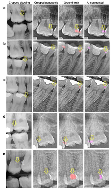 Examples Of Caries Misclassification Cropped Bitewing Radiographs Download Scientific Diagram