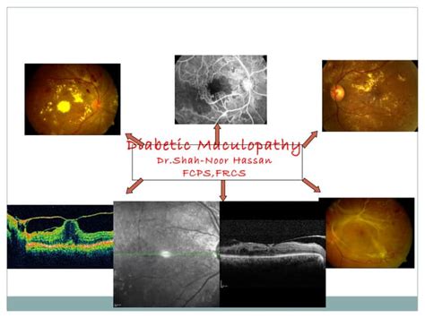 Diabetic Maculopathy Ppt