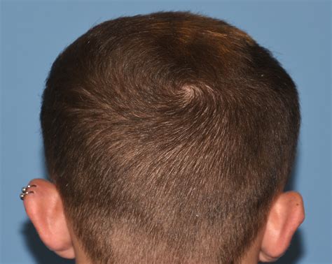 Young Male Temporal Reduction Back 1 Dr Barry Eppley Explore Plastic