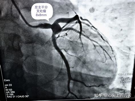 心脏搭桥手术，氯吡格雷应停止大于三天 知乎