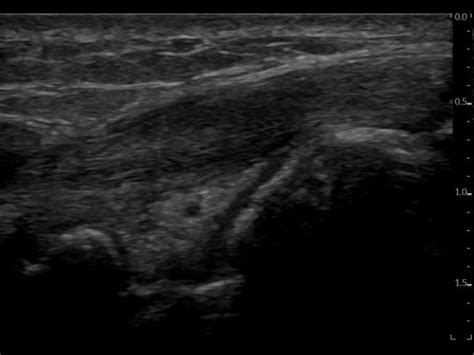 Partial Extensor Carpi Radialis Brevis Tendon Tear Ultrasound Cases