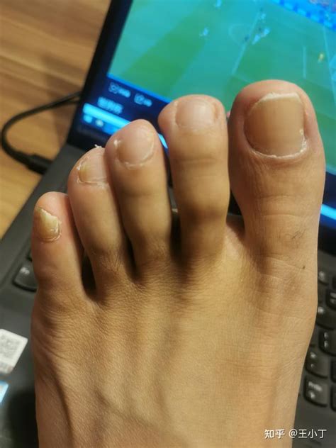 记录 治疗灰指甲疗程效果 知乎