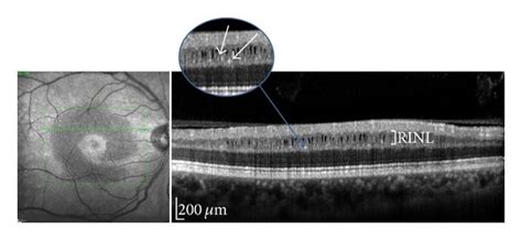 B Scan Sd Oct With Magnification Hyperreflective Pinpoint Lesions Download Scientific Diagram