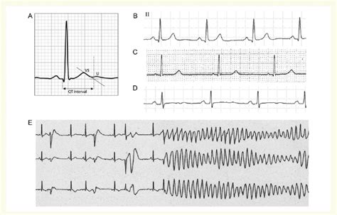 Figure A2 Measurements Of The QT Interval Examples Of T Wave Download Scientific Diagram