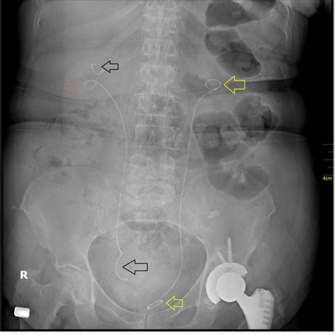 Double J Ureteral Stent