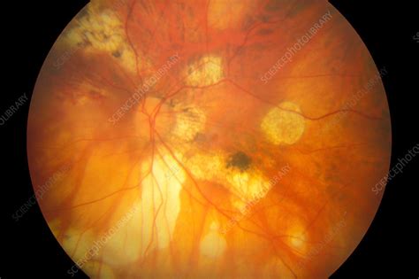 Degenerative Myopia Fundus Image Stock Image C034 5905 Science Photo Library