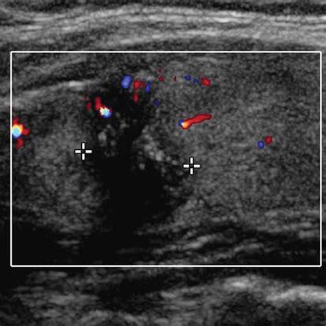 Role Of Ultrasound Diagnosis In Assessing And Managing Thyroid Nodules