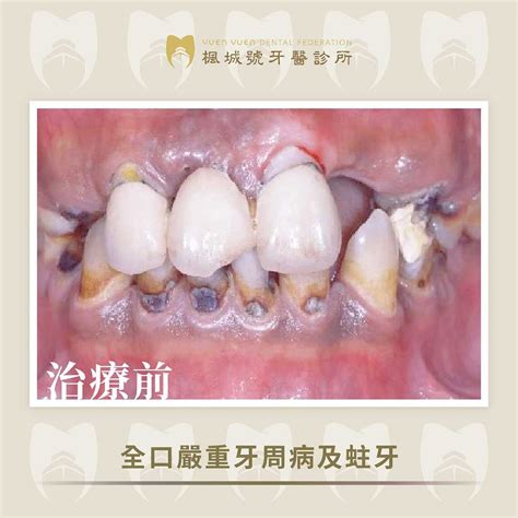 楓城號牙醫 牙科專科跨科合作 全口重建不是夢 👨‍🦰小帥化名因為長期吃檳榔，牙齒磨耗的又短又小顆 👾 也因為長期抽菸，牙齒染色嚴重