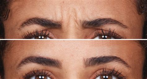 Before After Botox Frown Lines Kopelson Clinic