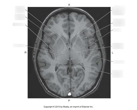 Axial T1 Weighted Mri Of Basal Nuclei Diagram Quizlet