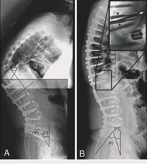 Figure 2 From The Intradiscal Osteotomy An Alternative Technique For Adult Spinal Deformity