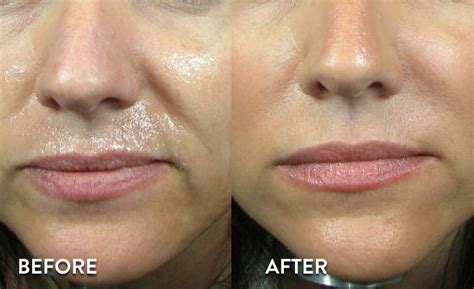Juvederm Before And After Pictures Voluma Vollure Juvederm Xc