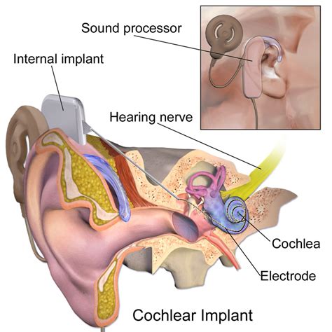 Cochlear Implants Canadian Hard Of Hearing Association
