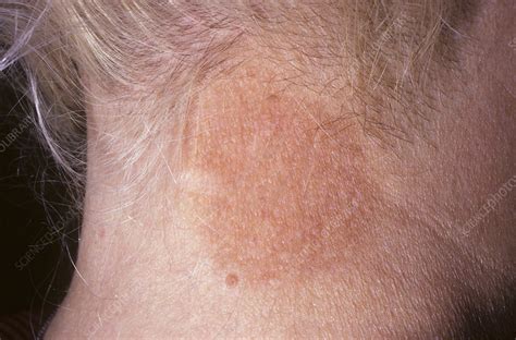 Lichenoid Skin Lesion Stock Image C040 2240 Science Photo Library