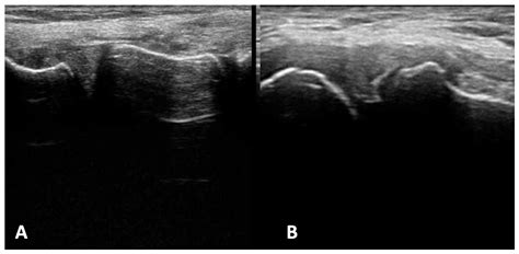 The Value Of Ultrasound Diagnostic Imaging Of Meniscal Knee Injuries