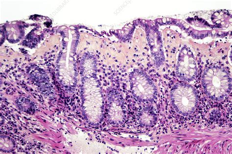 Collagenous Colitis Light Micrograph Stock Image M130 0874 Science Photo Library
