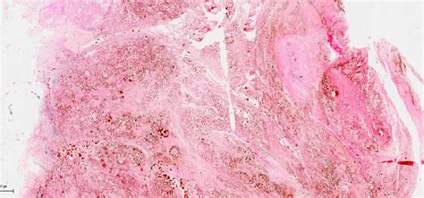 Acute Pancreatitis Histology