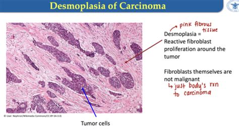 Neoplasia Classification Of Cancer Tumor Spread And Staging Vs Grading Flashcards Quizlet