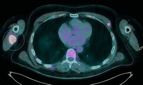 Multiple Hypermetabolic Nodular Lesions In Various Skeletal Muscle Download Scientific Diagram