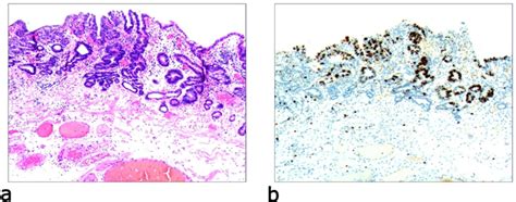 Glandular Atrophy Low Grade Intraepithelial Neoplasia A The