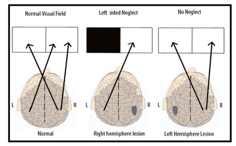 Ot Follow Up Right Neglect Rstroke