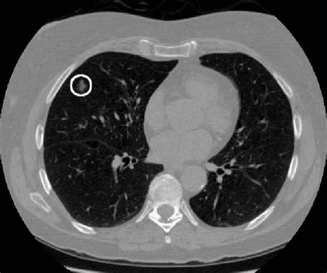 Deep Learning For Lung Cancer Detection Tackling The Kaggle Data Science Bowl 2017 Challenge
