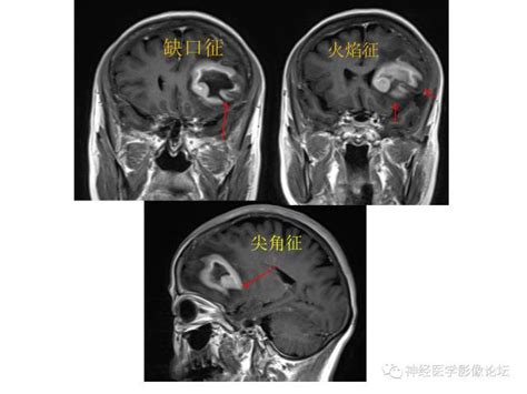【病例】左额叶淋巴瘤1例mr影像讨论 影像ppt
