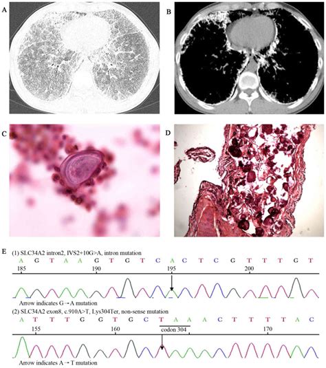 Pulmonary Alveolar Microlithiasis A Case Report And Review Of The