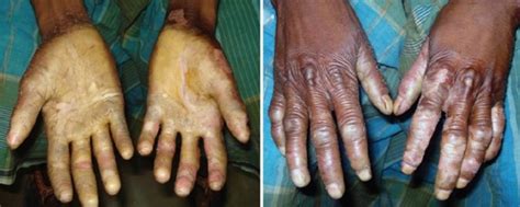 Transgradient Palmoplantar Keratoderma With Ill Defined Margins Download Scientific Diagram Transgradient Palmoplantar Keratoderma With Ill Defined Margins Download Scientific Diagram