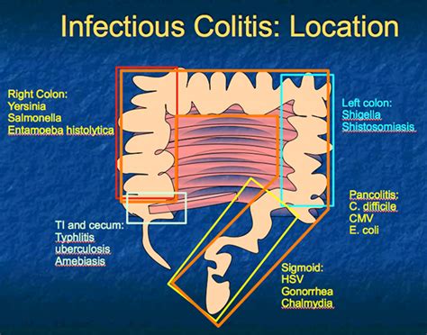 Infectious Colitis