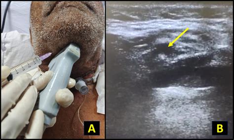 Technique Of Ultrasound Guided Intra Glandular Botulinum Toxin Download Scientific Diagram
