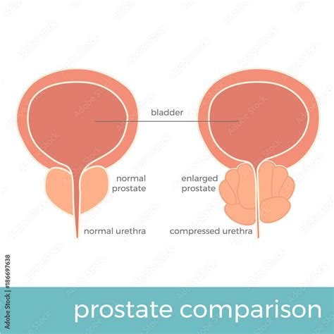 Vector Illustration Of Normal And Enlarged Prostate Comparison Vector