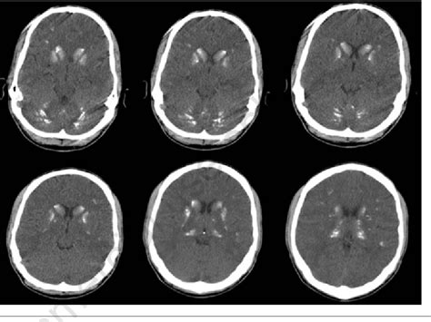 Figure 1 From Primary Hypoparathyroidism Presenting As Basal Ganglia Calcification Secondary To