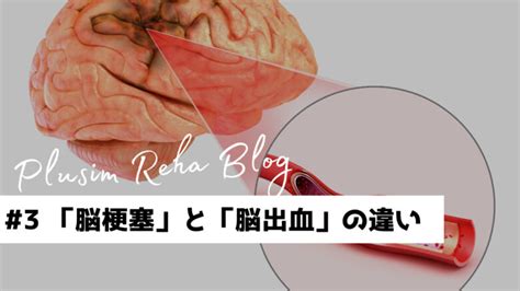 「脳梗塞」と「脳出血」の違い 脳卒中専門の保険外リハビリ｜plusim プラシム