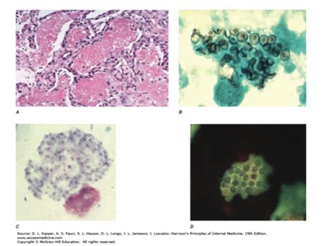 P Jirovecii And Viral Infections Flashcards Quizlet