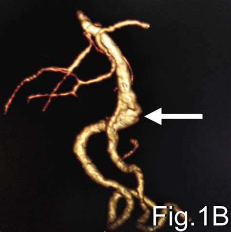 Ac Show The Mra Cta And 3d Dsa Respectively Of Basilar Artery Download Scientific