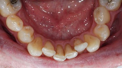 Case Gallery Clearcorrect