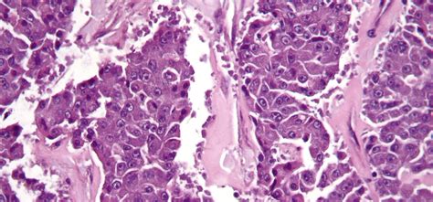 This Modified Common Cold Virus Specifically Targets And Kills Cancer And Leaves Healthy Cells