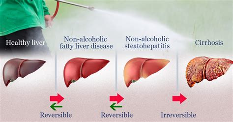Nutrients Free Fulltext Nonalcoholic Fatty Liver Nutrients Free Fulltext Nonalcoholic Fatty Liver