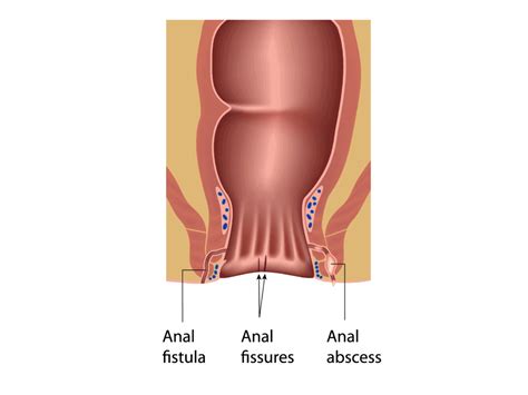 Anal Fissures