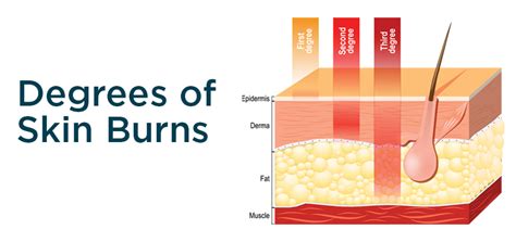 How To Cure Third Degree Burns Partskill30