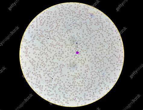 Microscopic View Of Thrombocytopenialow Platelet Counts Hematology