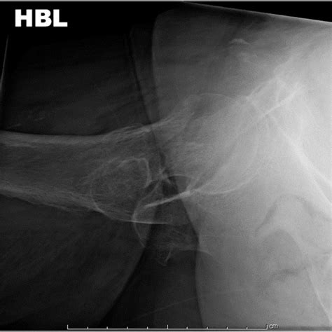 Ct Scan Images Showing Intracapsular And Extracapsular Fracture Neck Of Download Scientific