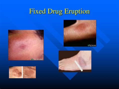 What Does Drug Eruption Mean At Lea Blackburn Blog