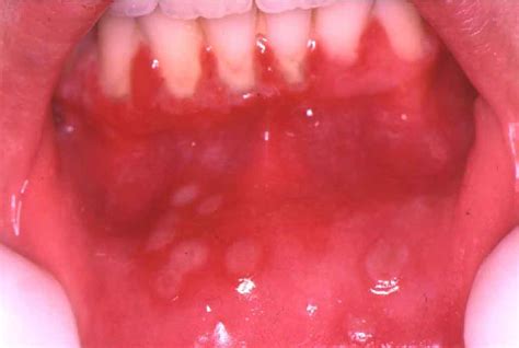 Oral Herpes Herpes Causes Symptoms And Treatment