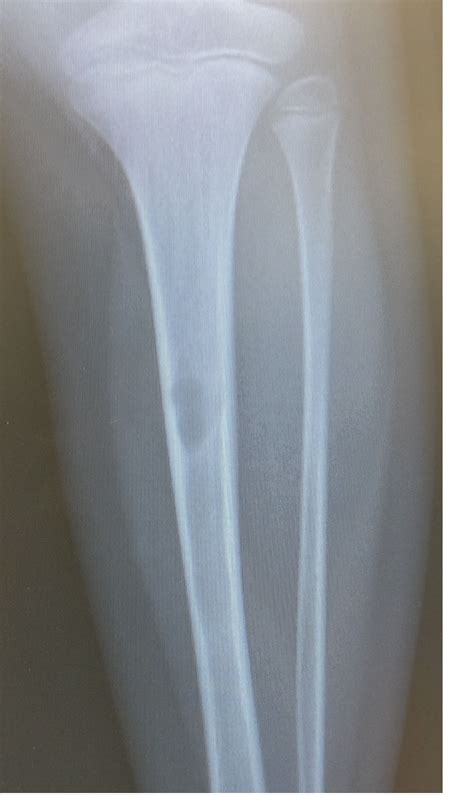 Monostotic Fibrous Dysplasia Of Proximal Tibia A Case Report Orthogate