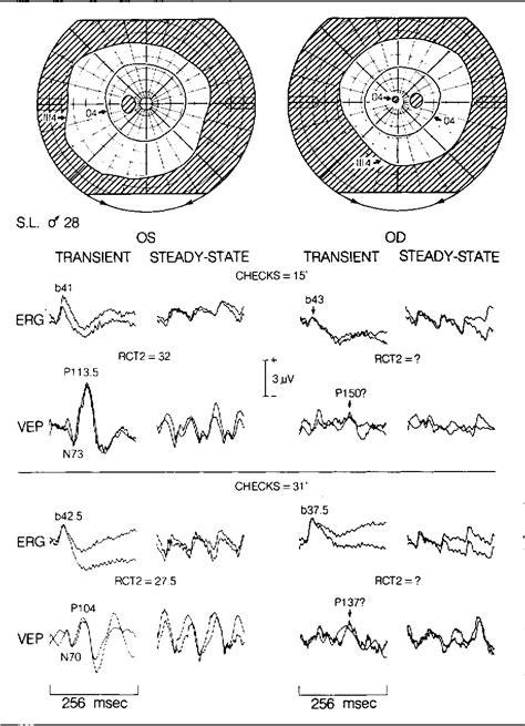 Figure 1 From Simultaneous Recording Of Pattern Electroretinogram And