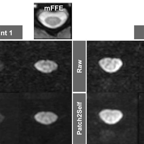 Denoising The Diffusion Weighted Images Qualitatively Improves Tissue