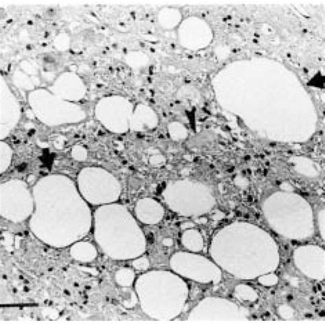 Multiple Axonal Spheroids Arrows In The Lateral Cuneate Nucleus Of A