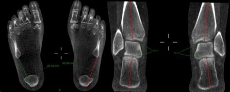 Styloid Process Foot